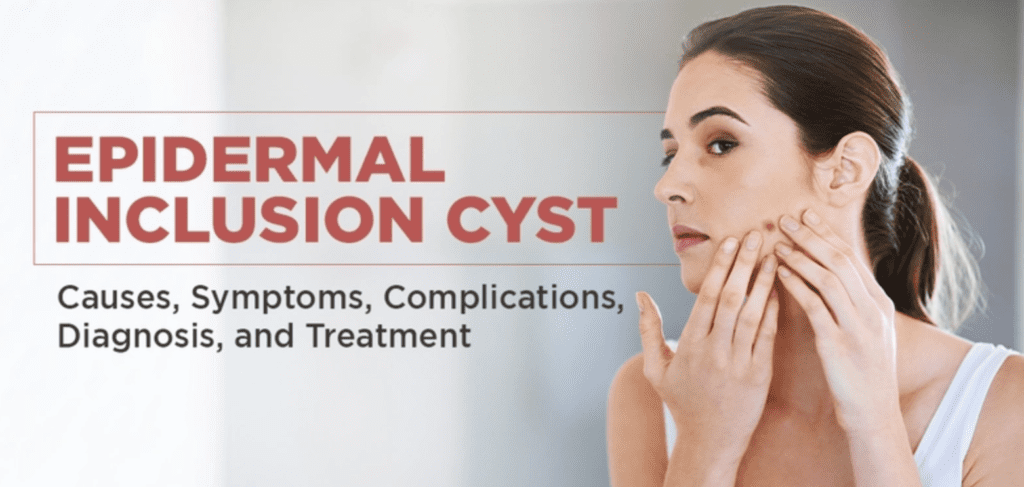 Epidermoid Cysts of the Skin - UVTREAT: Phototherapy: UVB Lamp for ...