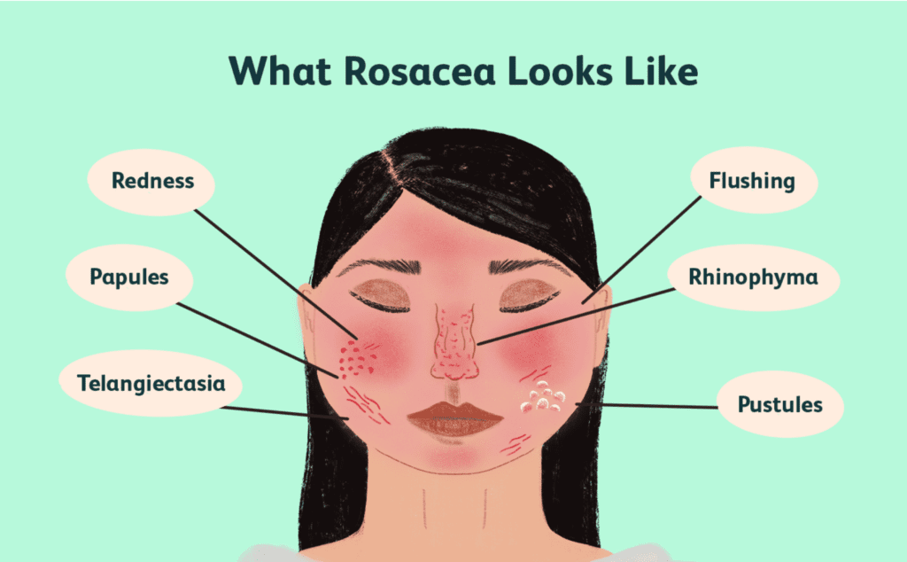Rosacea: Symptoms, Causes, and Treatments