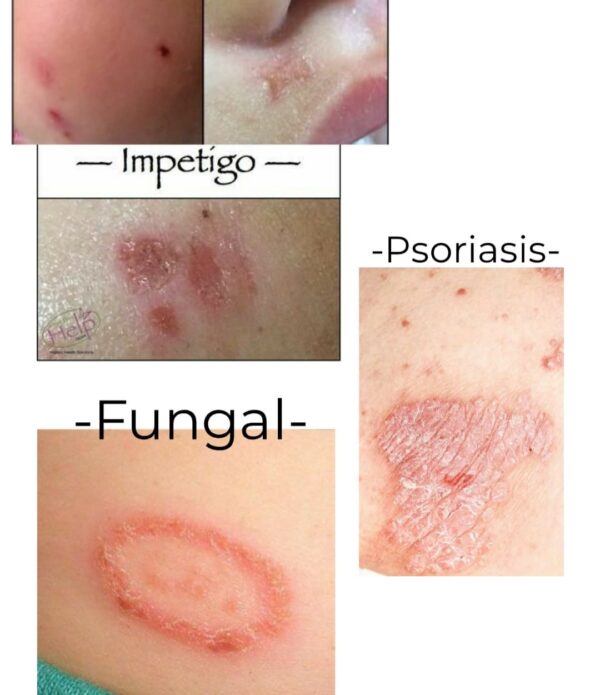 Psoriasis vs. Fungal Infection: 6 Tips for Identification