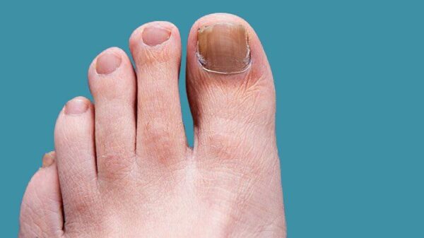 TOENAIL FUNGUS: How to Treat Toenail Fungus With UV Light