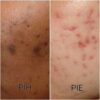 PIE and PIH Acne Marks – What's The Difference, Treatments?